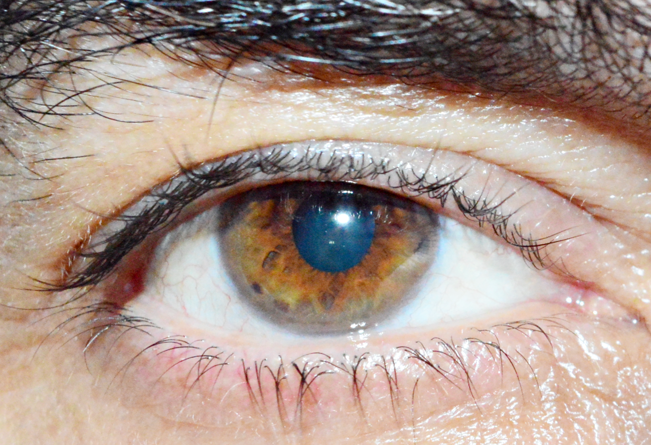 'Poppers' might permanently damage your eyes