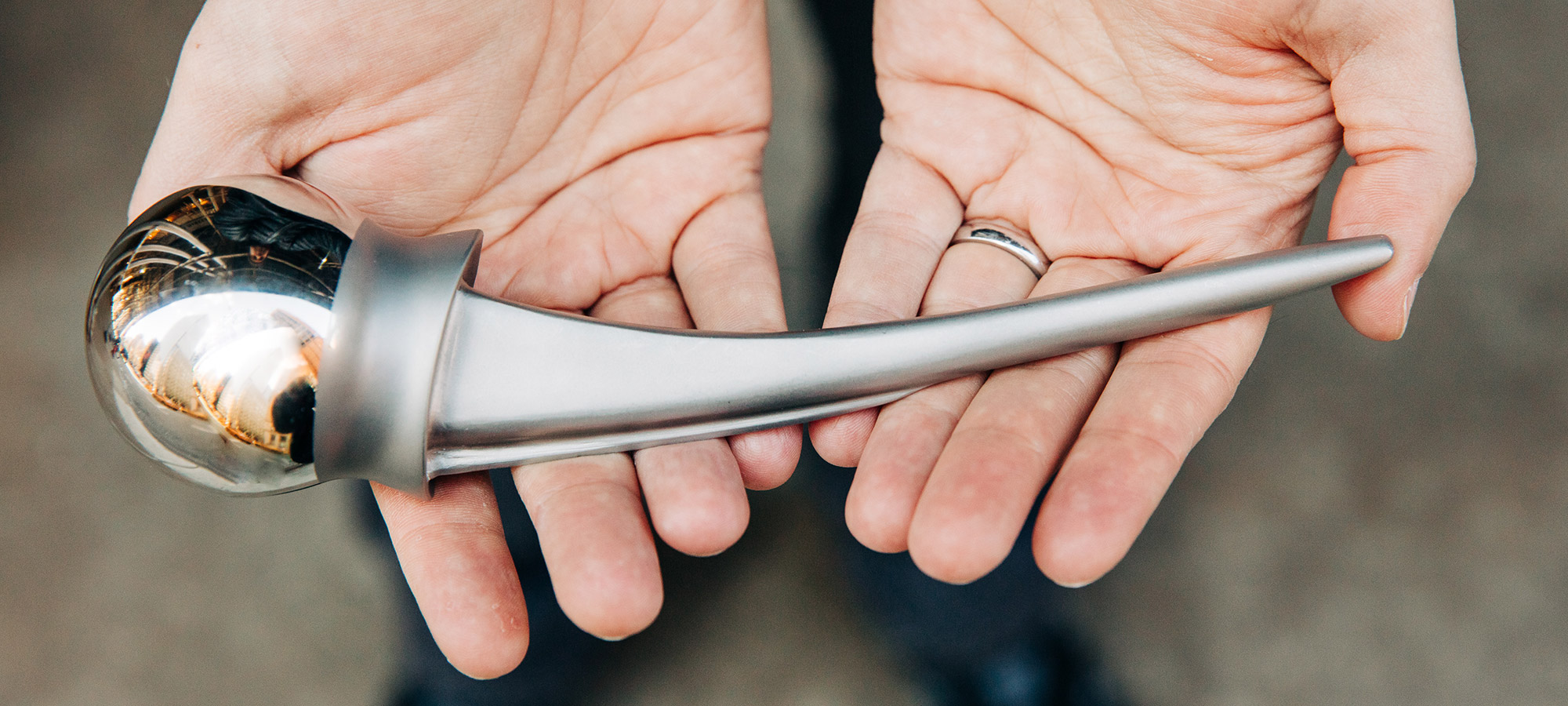 I got my hip replaced at 39. Here’s why that might get more common.