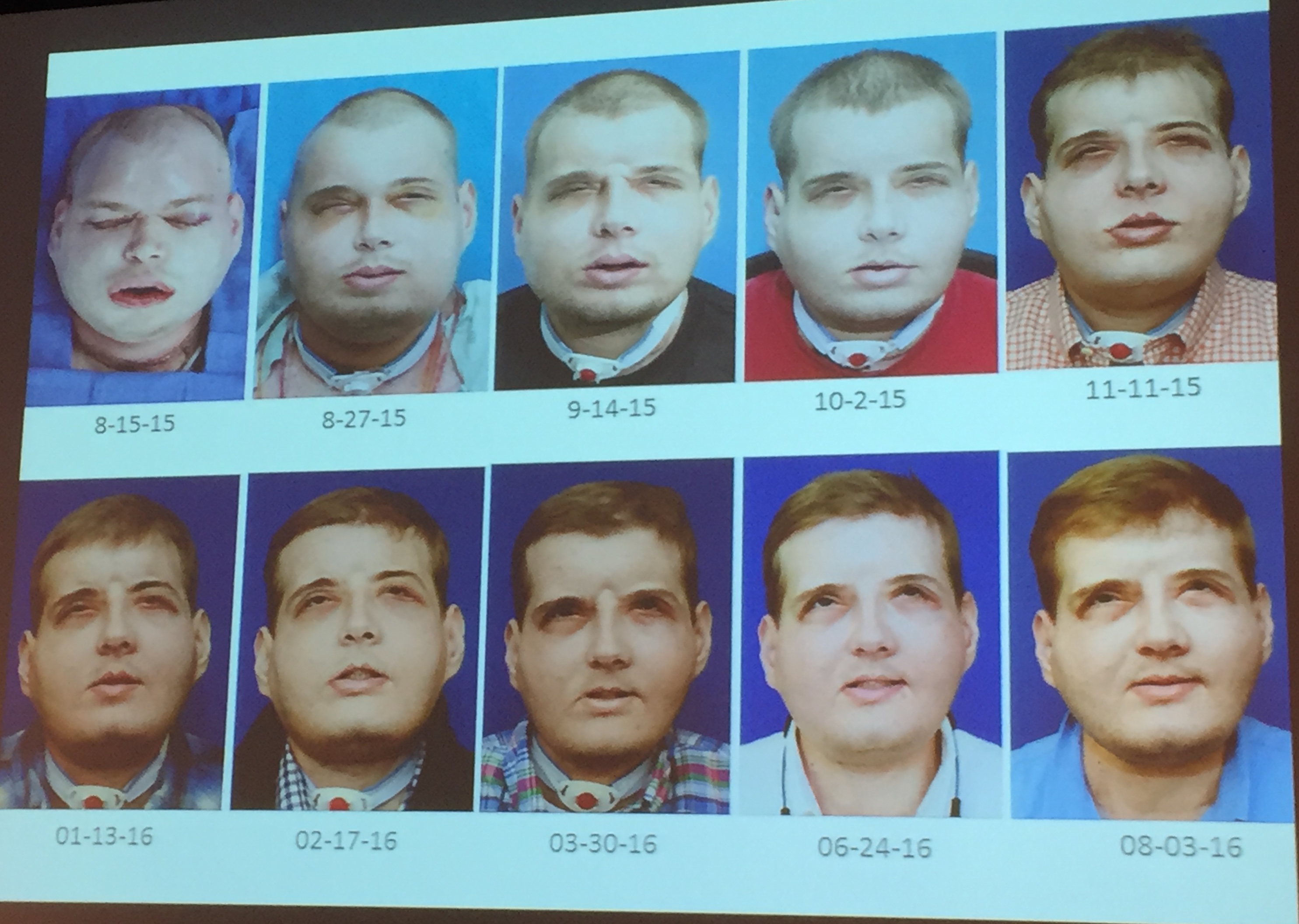 One Year Later, Face Transplant Recipient Just A Normal Guy
