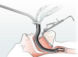 Slither of Hope: Surgical Snakebots Are Real, And Heading For Humanity ...