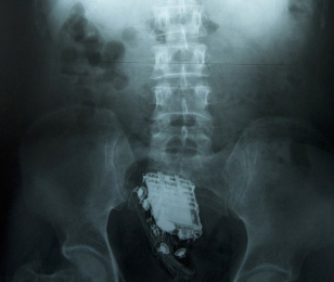 FYI: How Much Cocaine Can You Fit In Your, Ahem, Body?