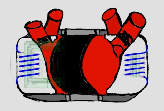 No Pulse: How Doctors Reinvented The Human Heart