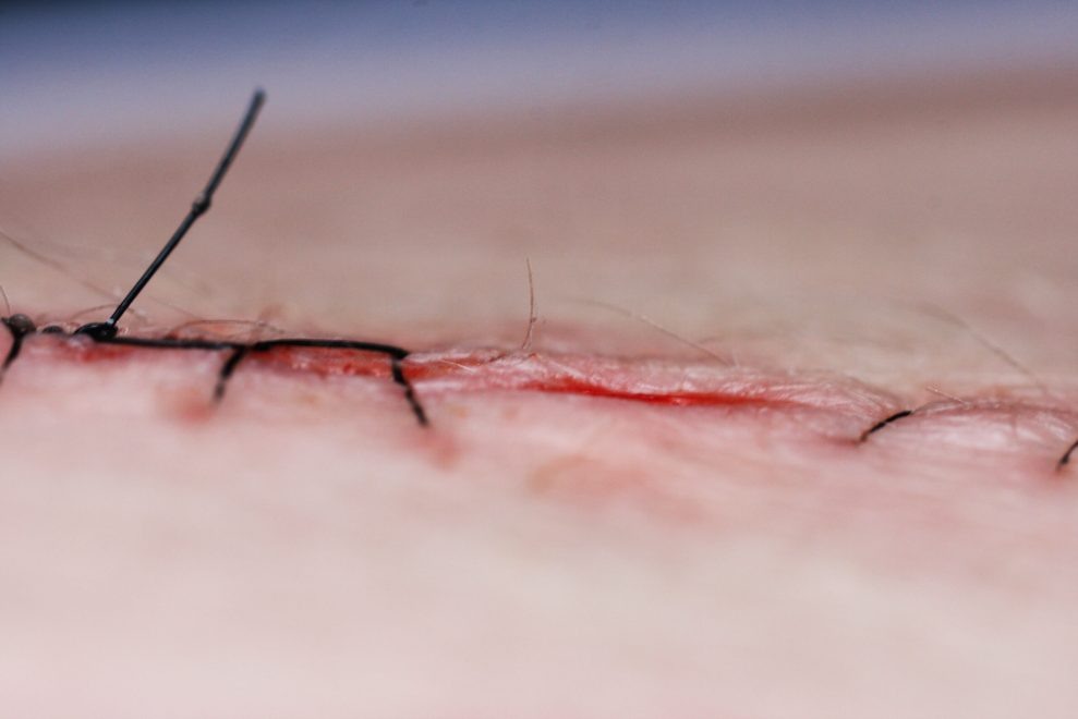 Bandage Changes Color to Indicate State of Wound Underneath