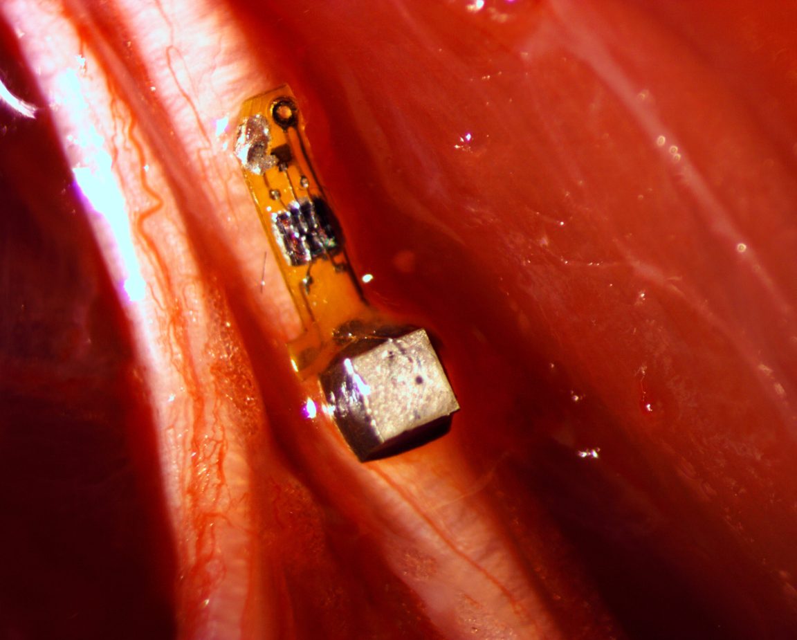 Wireless 'Neural Dust' Could Monitor Your Brain