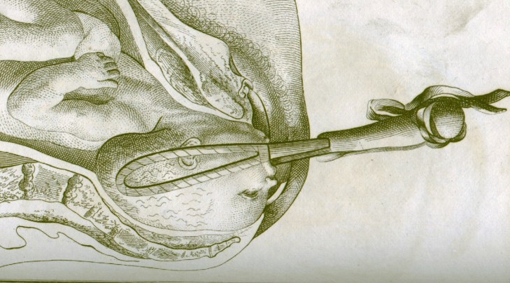 Forceps changed the way people give birth