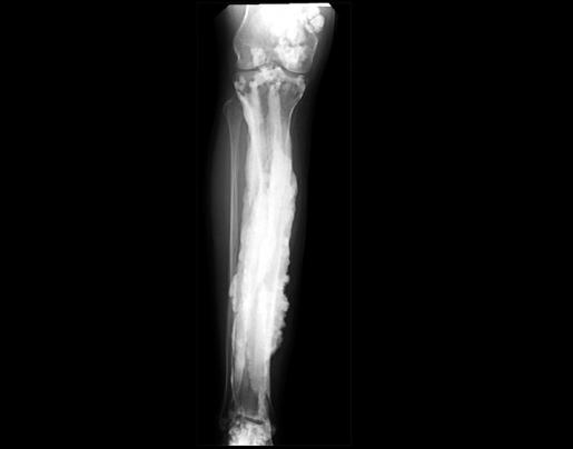Six rare bone disorders you probably haven’t heard of