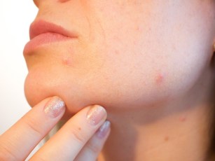 This popular acne medication carries a disturbing legacy