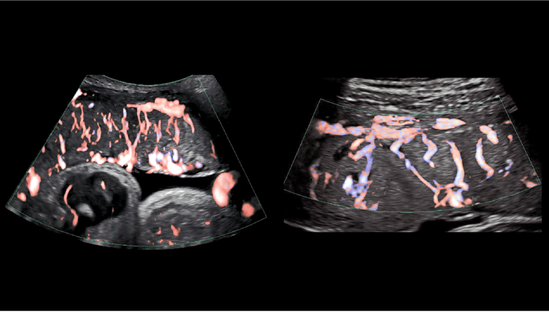 Placenta health and research is a new priority for doctors | Popular ...