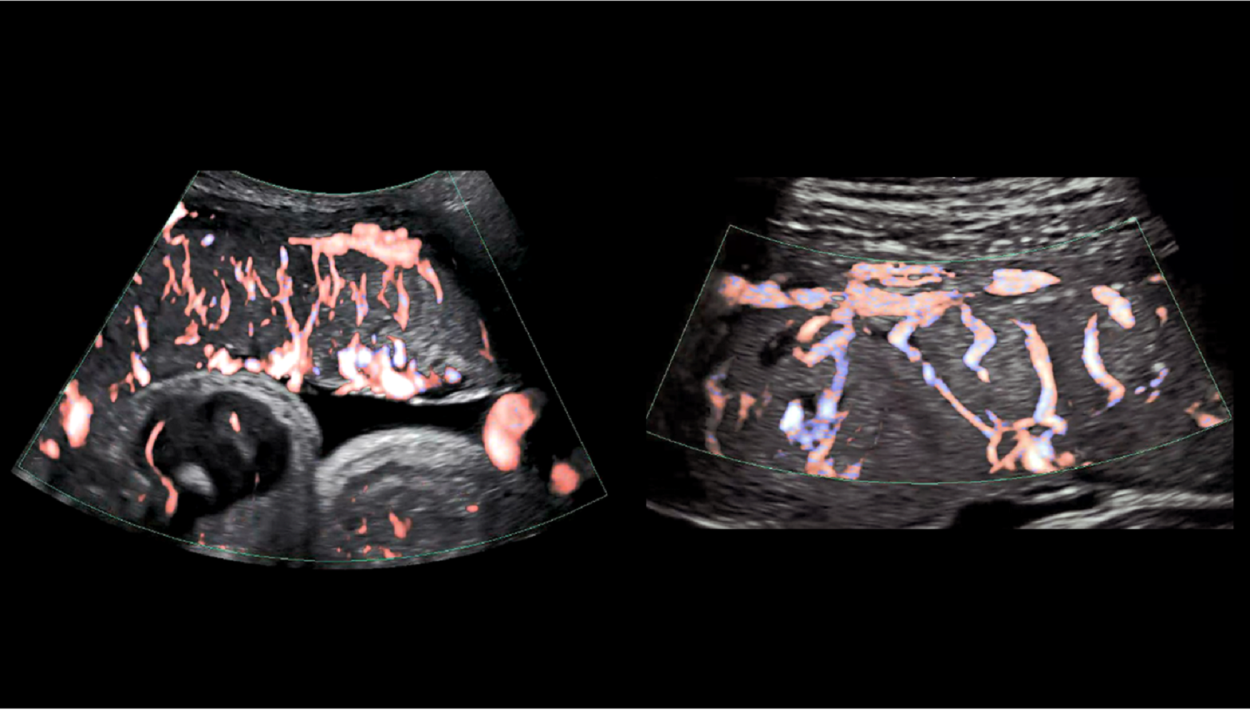Placenta health and research is a new priority for doctors | Popular ...