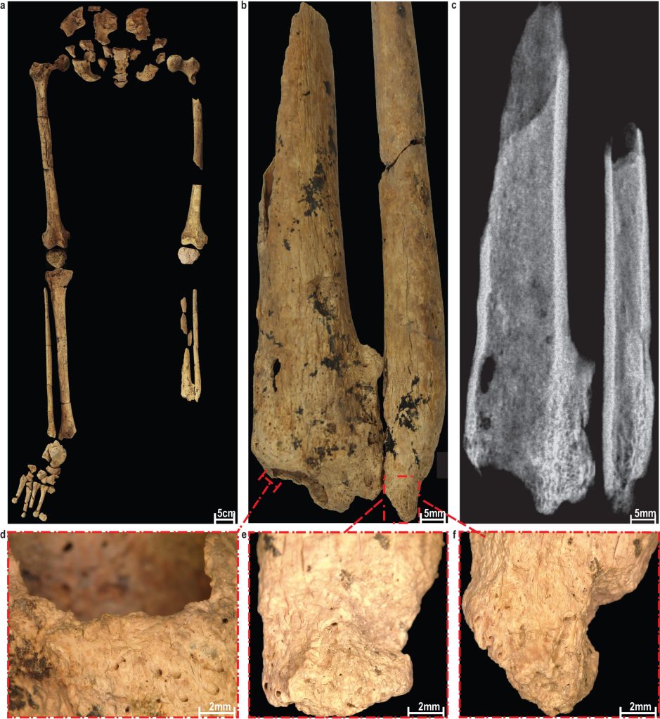 Borneo burial is the earliest known amputation patient | Popular Science