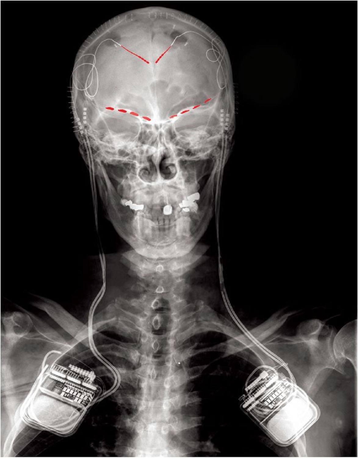 Doctors measured chronic pain from brainwaves | Popular Science