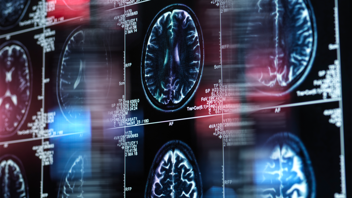 Common brain circuit could be connected to substance use disorder ...