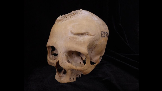 4,000 year-old Egyptian skulls show attempts at brain surgery to treat ...