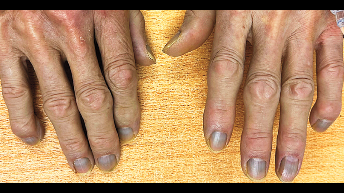 Mysterious silver poisoning turned an 84-year-old gray for good ...