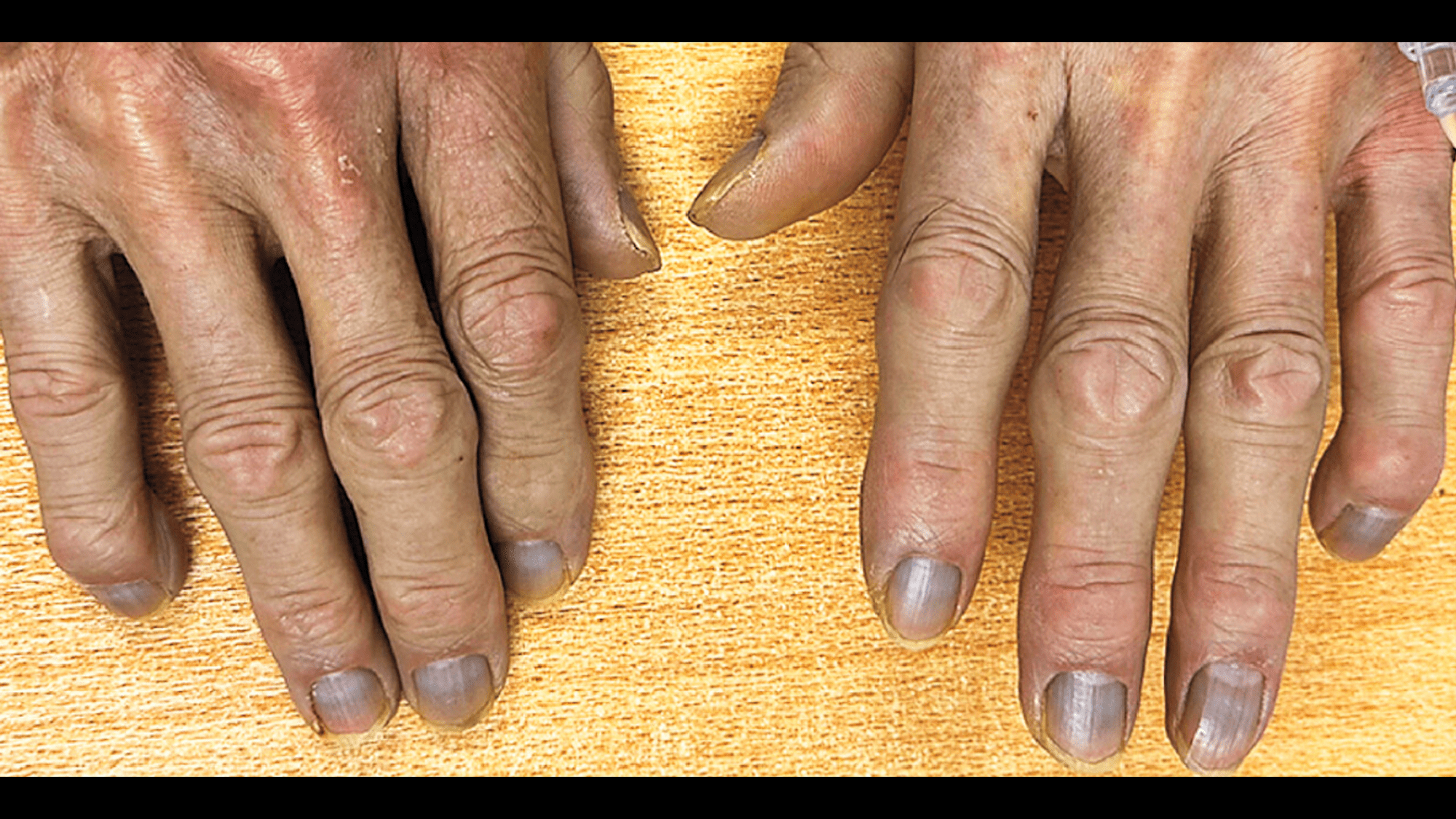 Mysterious silver poisoning turned an 84-year-old gray for good ...