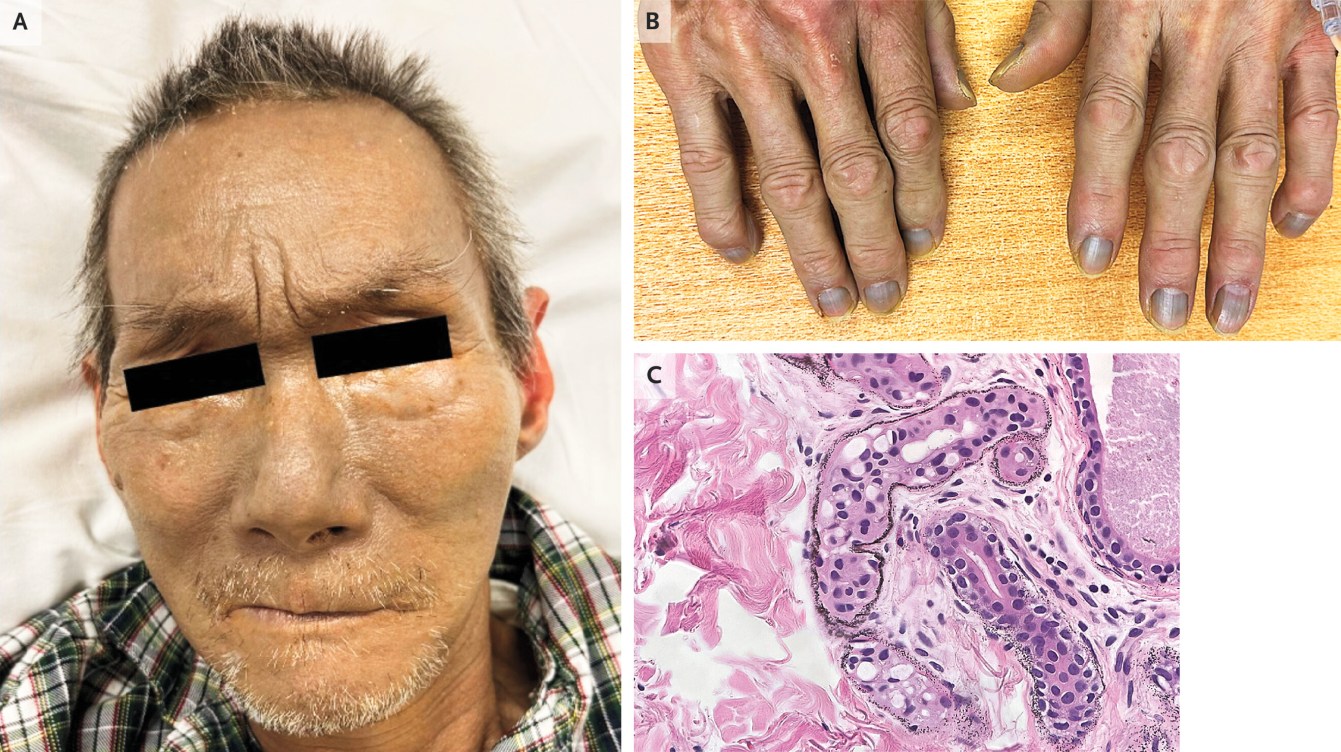 Mysterious silver poisoning turned an 84-year-old gray for good ...