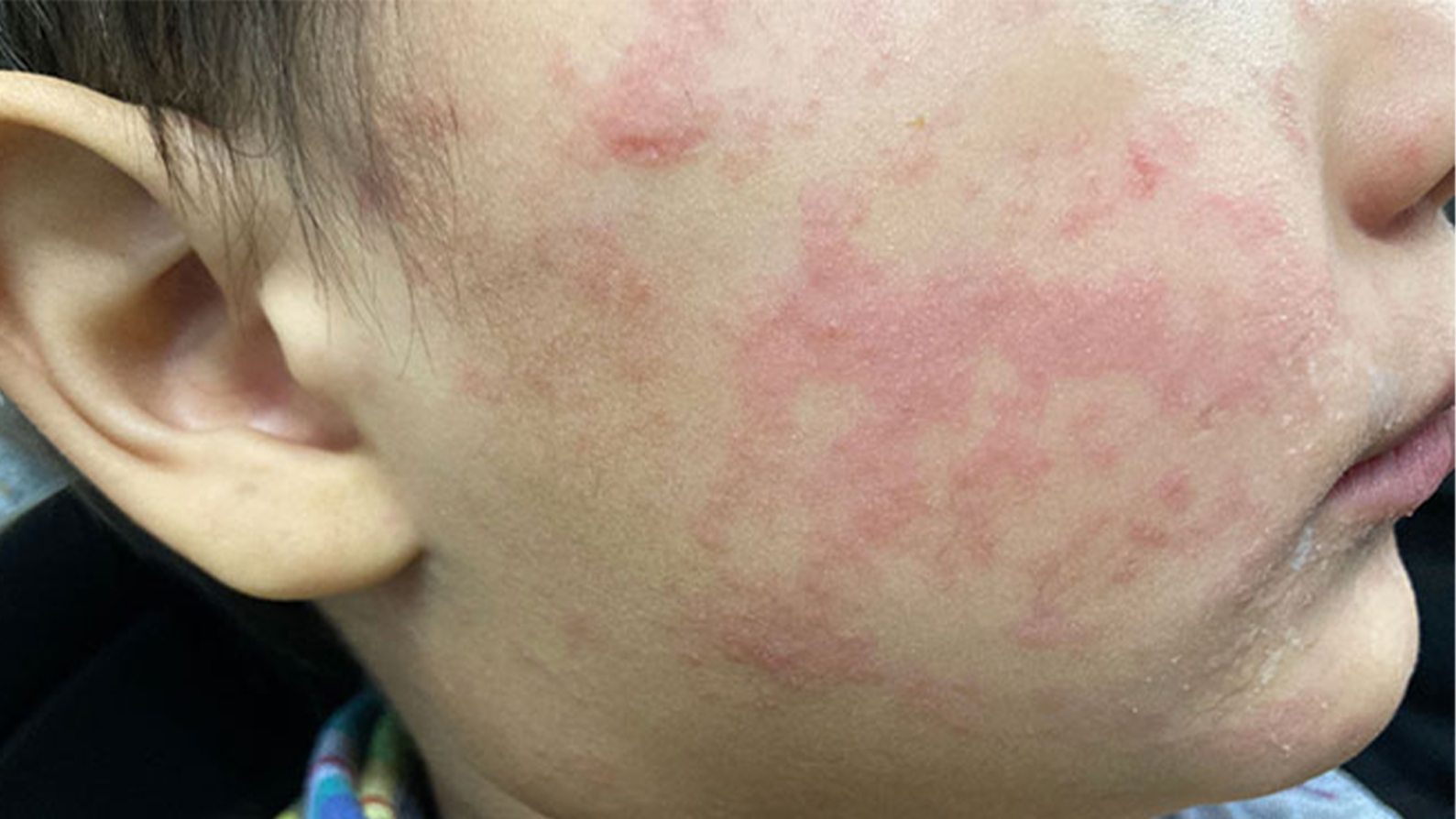 The shaky science behind treating measles with vitamin A | Popular Science