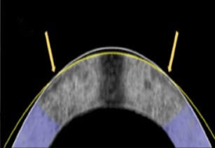 LASIK without the laser? Rabbit eyeballs hint at a new option | Popular ...