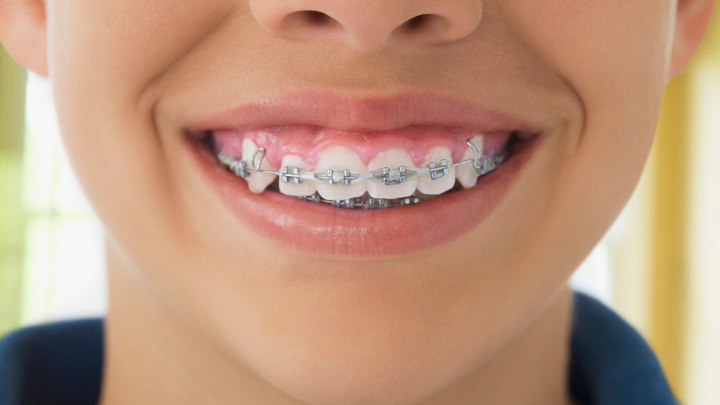 Ancient humans didn’t need braces. So why do we? | Popular Science